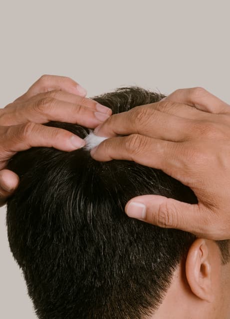 Buy Prescription Topical Finasteride and Minoxidil Foam Online | Keeps